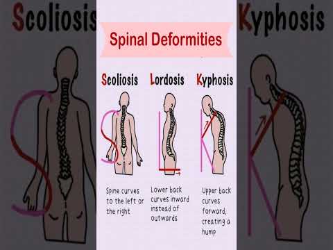 Understanding Spinal Deformities: Scoliosis, Lordosis, and Kyphosis