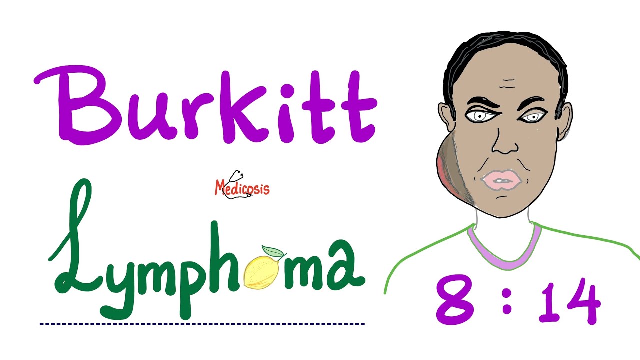 Burkitt’s Lymphoma - Aggressive B-Cell Neoplasm - Non-Hodgkin’s Lymphoma - Fastest Growing Cancer!!