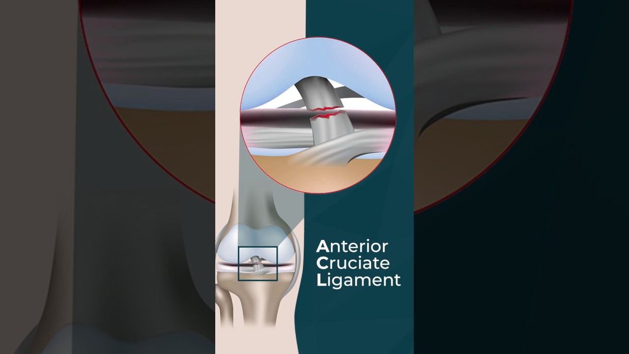 What is an ACL TEAR? - Dr Bernard Lee - Shoulder | Elbow Orthopaedic Group