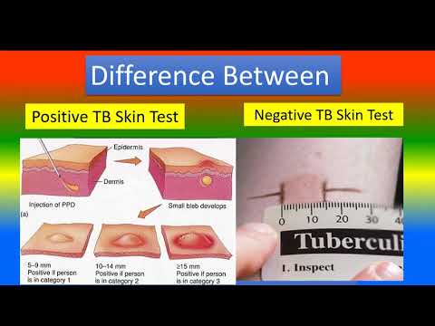 Difference Between Positive TB Skin Test and Negative TB Skin Test