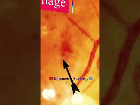 Retinal hemorrhage | Diabetic retinopathy | Fundus Photography | Short Video 106 #optometry