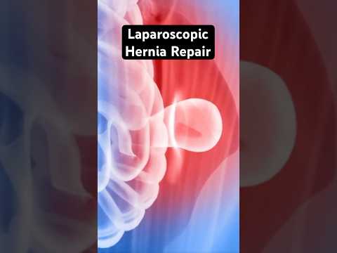 Pushing a hernia back into place (3D Animation)