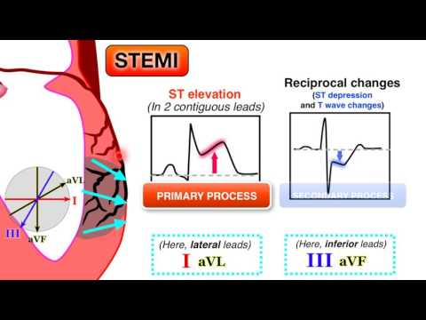 Ischemia 6/7 - STEMI on ECG