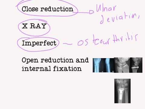styloid process of radius (chauffeur's fracture) (ulf2)