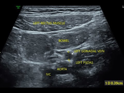 Nutcracker syndrome with left varicocele - Ultrasound