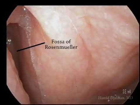 Fiberoptic nasopharyngoscopy