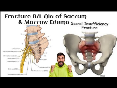 Fracture of bilateral ala of sacrum and Marrow edema | MRI LUMBO-SACRAL SPINE AND TIM