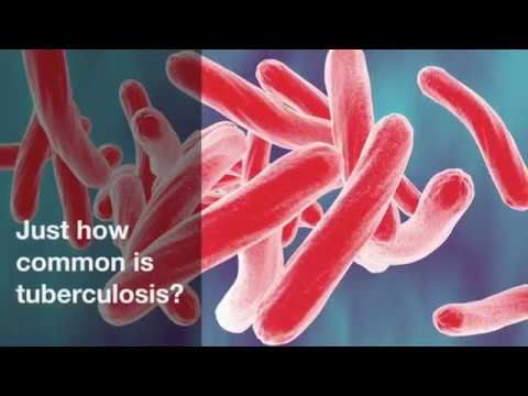 How common is tuberculosis?