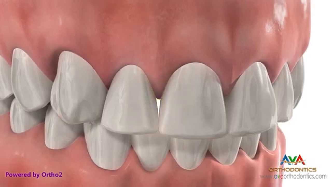 Interproximal Reduction or IPR - Disc