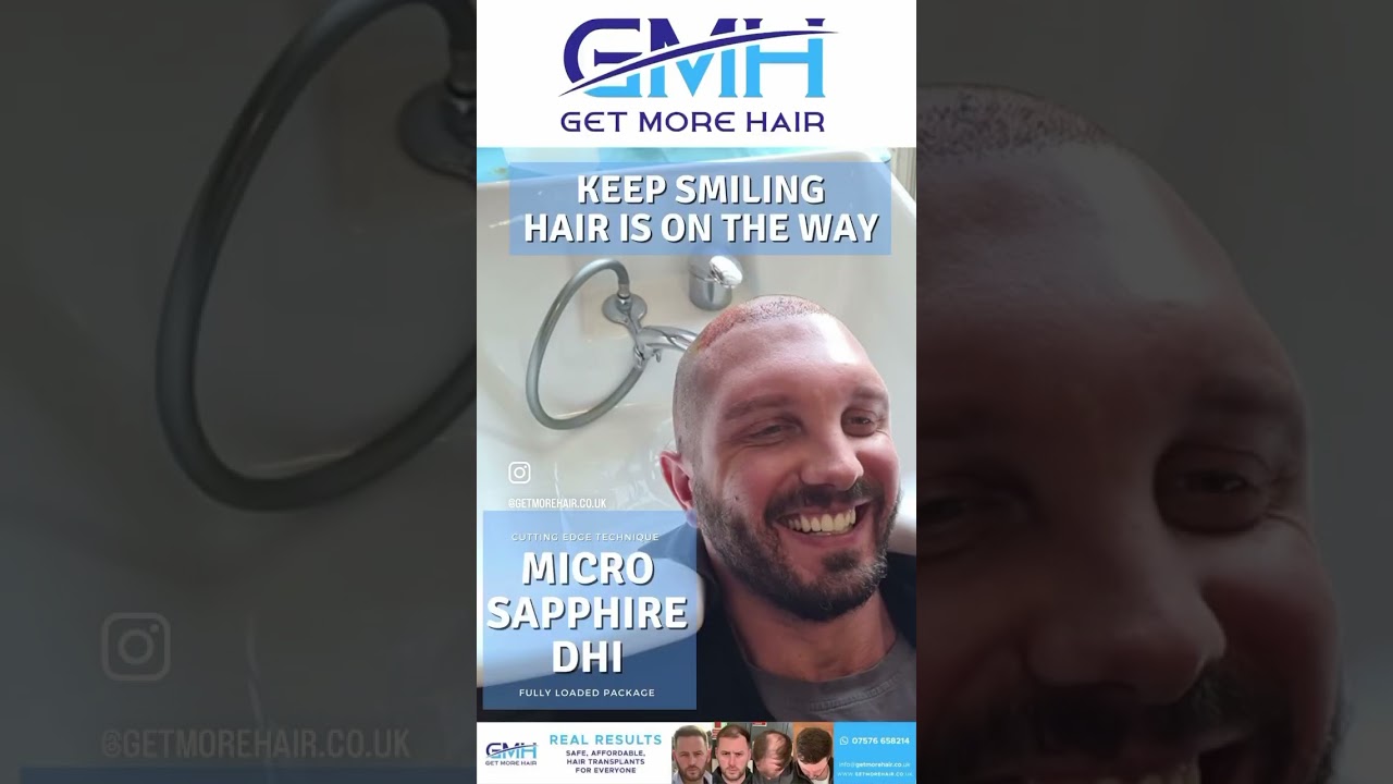 STOP SCROLLING! Witness Brazzers star Quinton James’ mind-blowing hair transplant