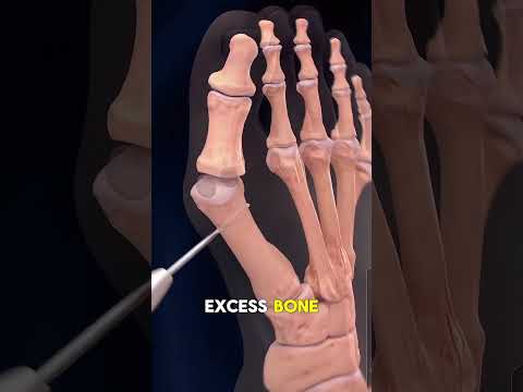 How Bunionectomy Surgery Is Performed? (3D Animation) #3dmedicalanimation #anatomy