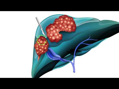 What is a biopsy?