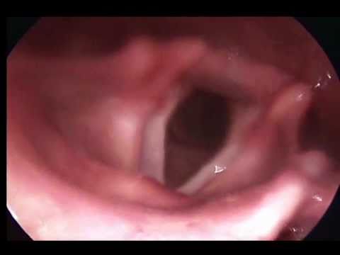 My Larynx