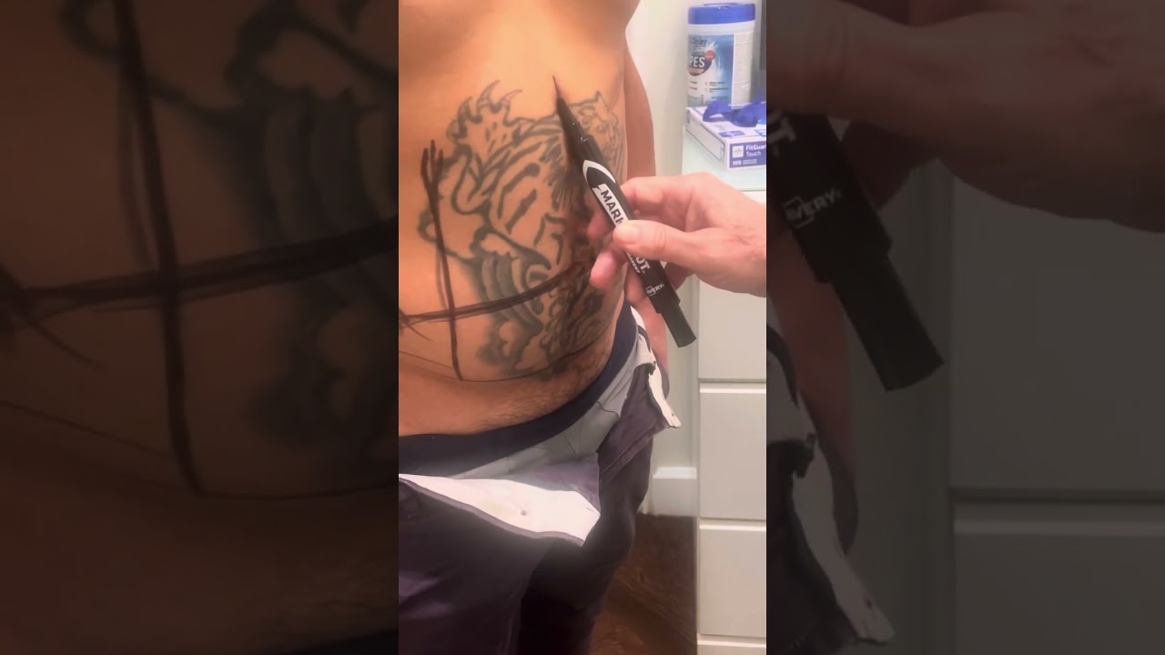 Abdominal Etching + Lipo - Creating Six Pack