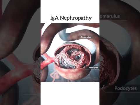 IgA nephropathy #IgANephropathy #KidneyDiseaseAwareness #ChronicKidneyDisease #RenalHealth #nephrone