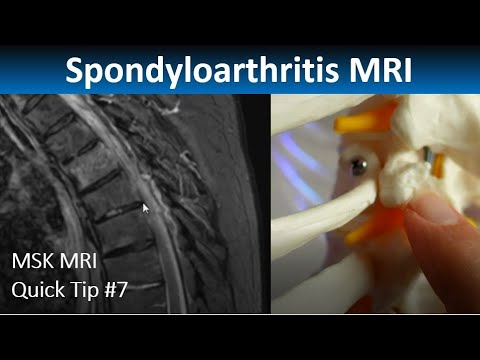 MRI in Axial Spondylarthritis: Thoracic Spine Inflammation (MSK MRI Quick Tip)