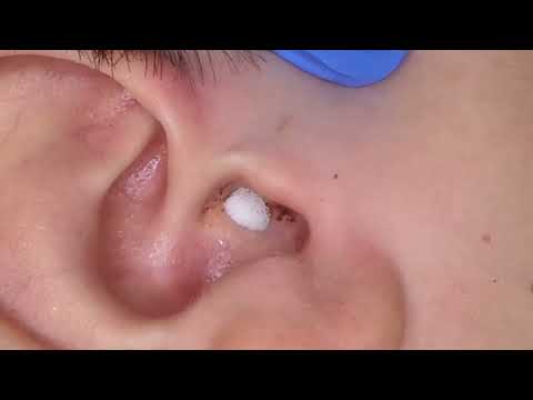 Nasal Pack - Merocel Pack Latest Price, Manufacturers & Suppliers