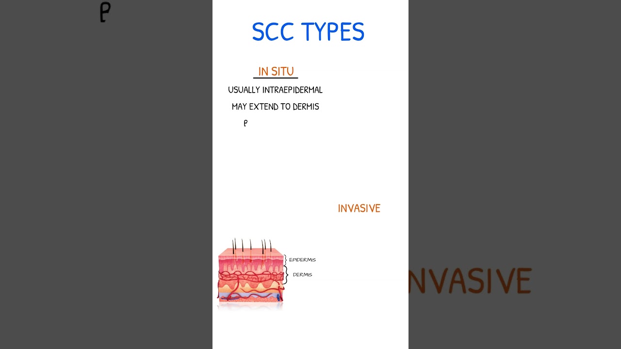 SQUAMOUS CELL CARCINOMA Types