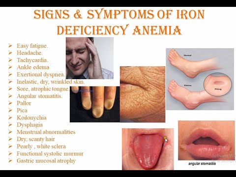 Iron Deficiency Anemia , Overview ,Causes, Signs & Symptoms, Diagnosis, Treatment #mbbs #mbbslife
