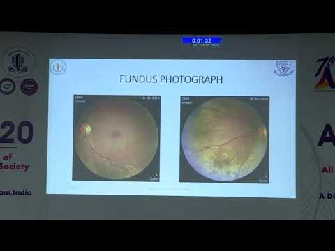 AIOC2020 HydePark V Dr Apoorva goel FUNDUS ALBIPUNCTATUS AN INCIDENTAL FINDING