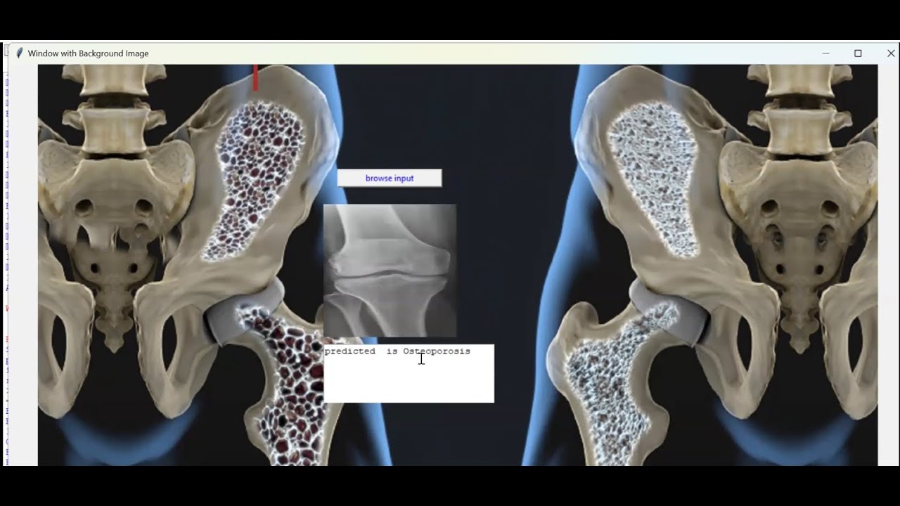 Osteoporosis detection and classification using deep learning algorithm | best project center in ban