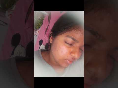 Chicken pox stages #shorts