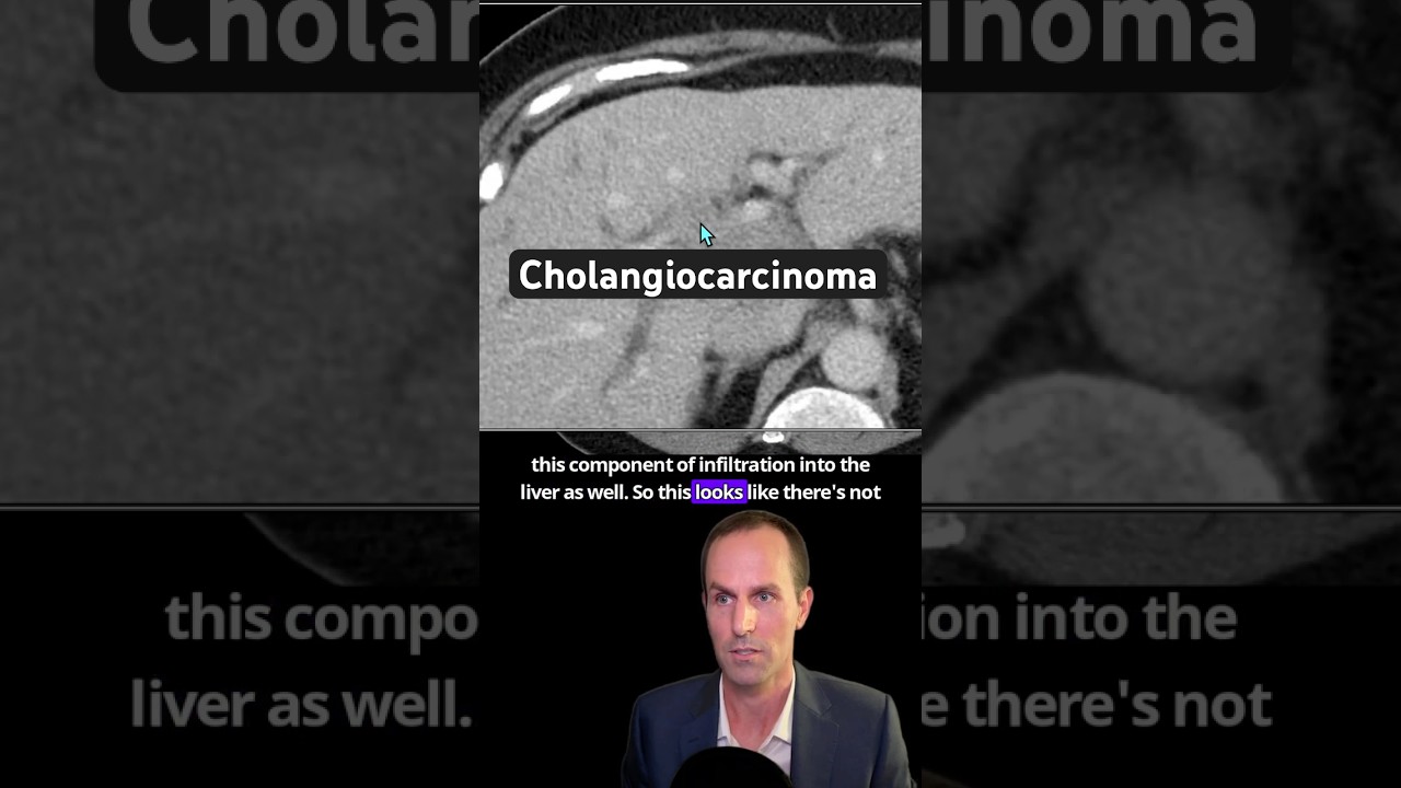 Abdominal CT Tutorials - Cholangiocarcinoma (Klastkin)