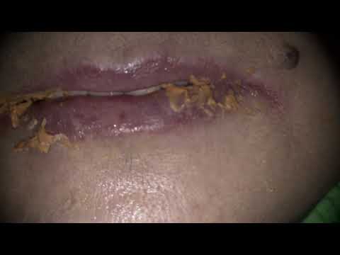 BPS Straumann Implant overdenture imp with Locator