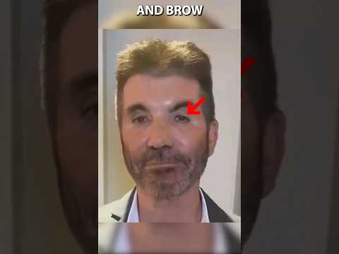What Happened to Simon Cowell's Face?