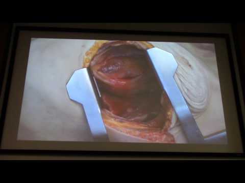 ED Thoracotomy Indications and technique Part 1