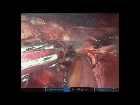 Robotic Hysterectomy with Significant Adhesions