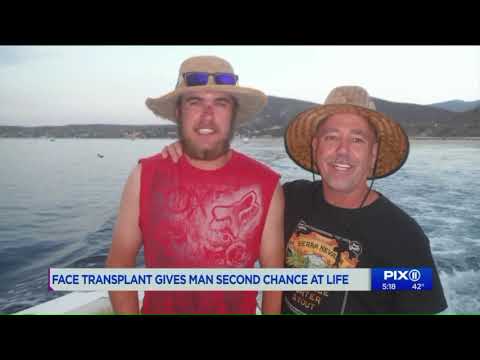 Face transplant patient reveals new face months after surgery at NYU Langone Health