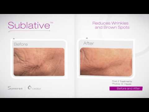 eMatrix Sublative Skin Rejuvenation Utah