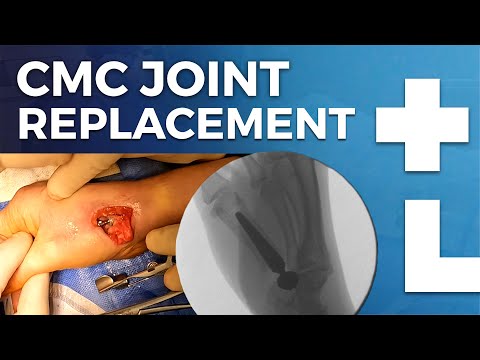 CMC joint replacement - thumb arthritis treatment - Hubert Laprus MD PhD - Dworska hospital®