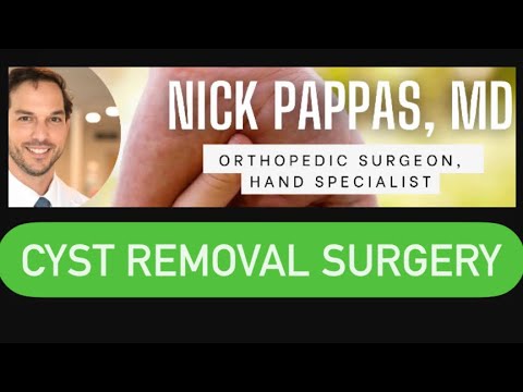 Removal of a benign epidermal inclusion cyst from the finger #InclusionCyst #Cyst #Finger #Surgery