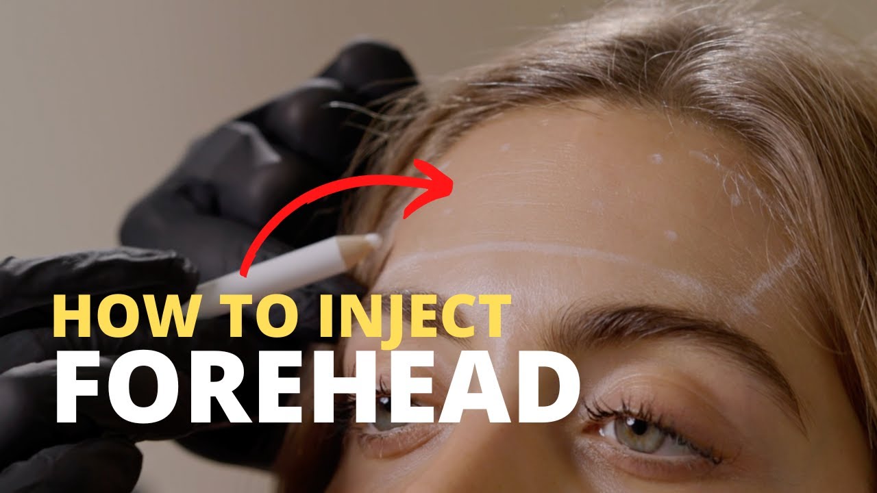 The most RELIABLE forehead injection technique