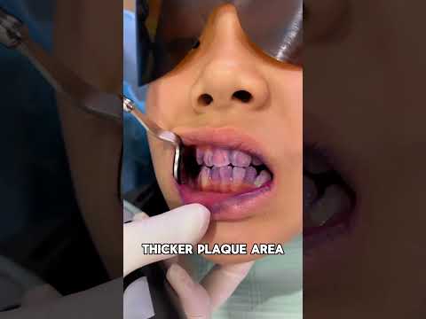 How do Disclosing tablets work  #dentist #smile #beauty