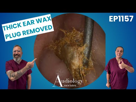 Three Surprising Ear Cleanings in One Video! - EP1157