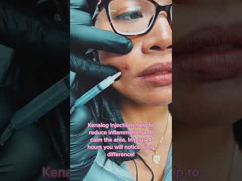 Cure to Cystic Acne FOUND 👁