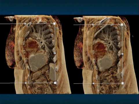 CT of the Chest with a Focus on the Mediastinum: Interesting Cases and What We Can Learn - Part 1