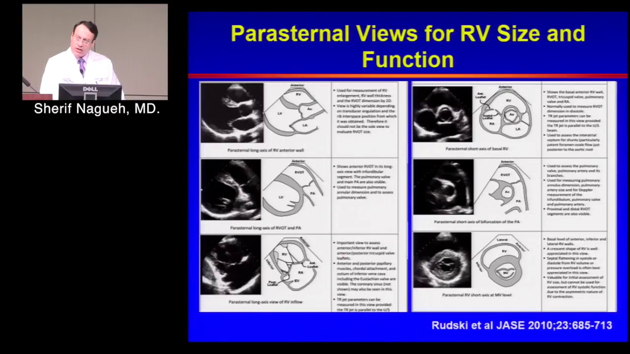Echocardiographic Assessment of RV Function
