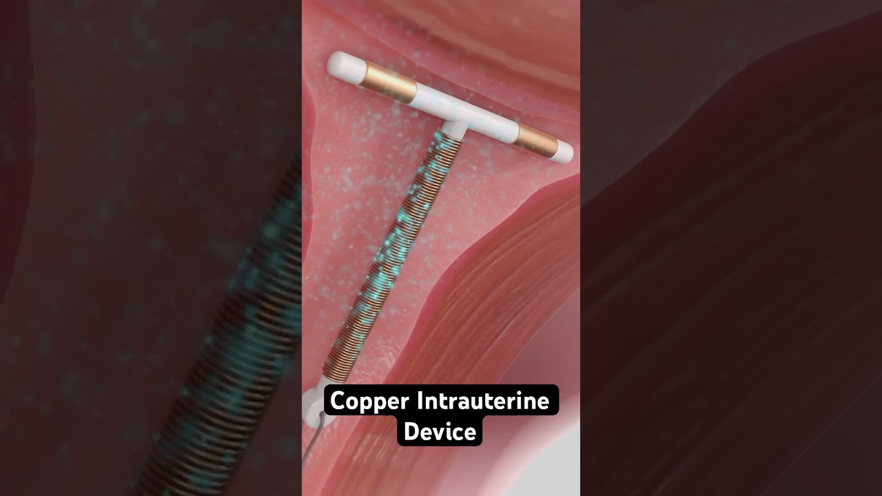 Copper IUD Birth Control (3D Animation)