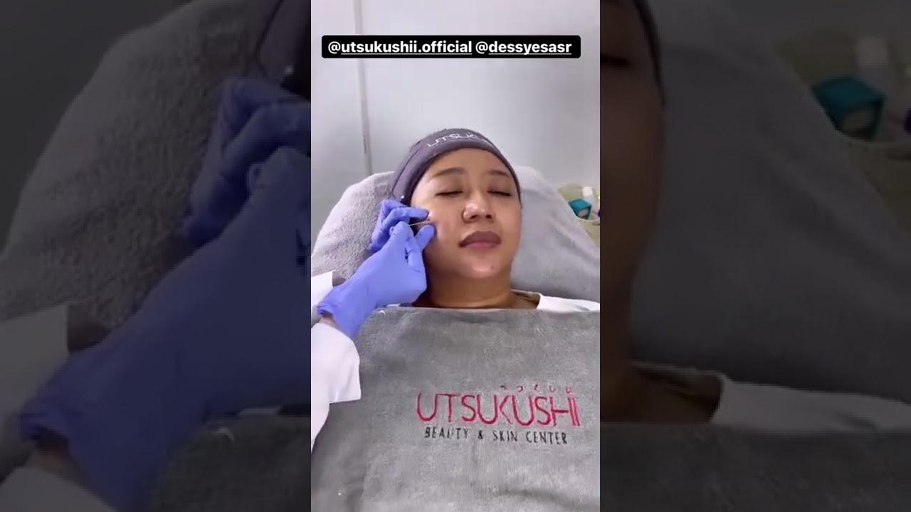 Treatment filler undereye untuk mata panda