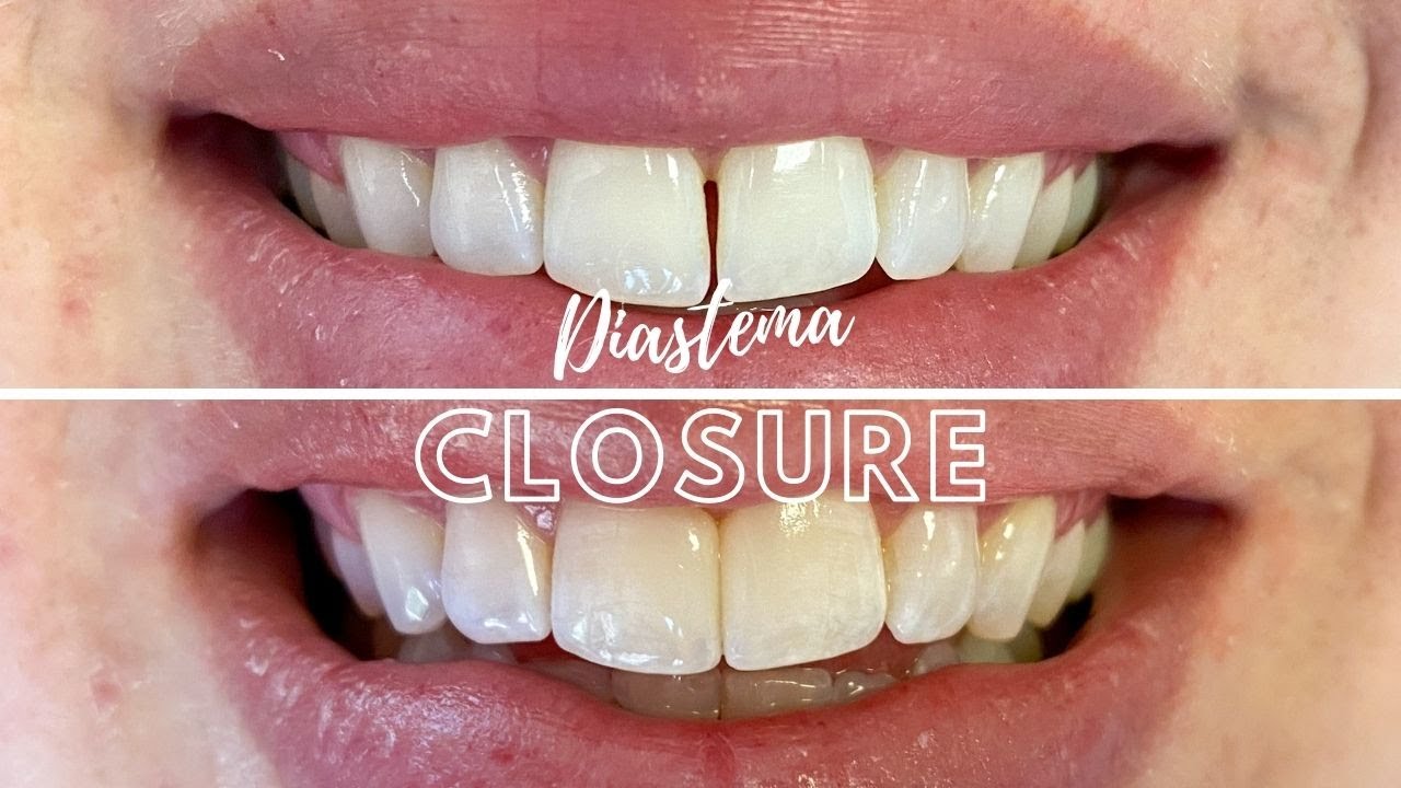 Diastema Closure - created with Bioclear Matrix