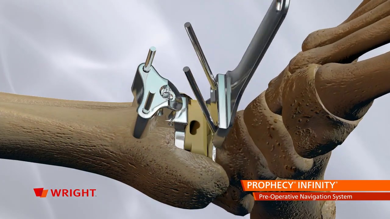 INFINITY™ Total Ankle System featuring PROPHECY™ Preoperative Navigation