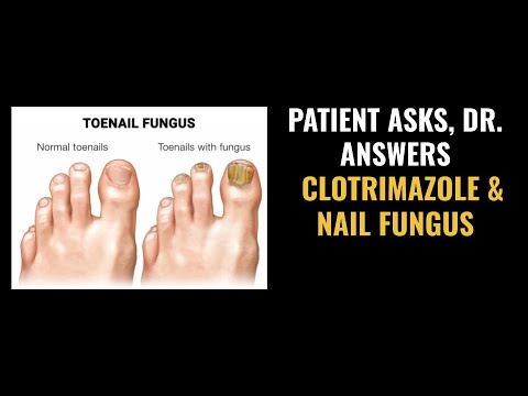 Is Clotrimazole The Best Treatment for Nail Fungus???