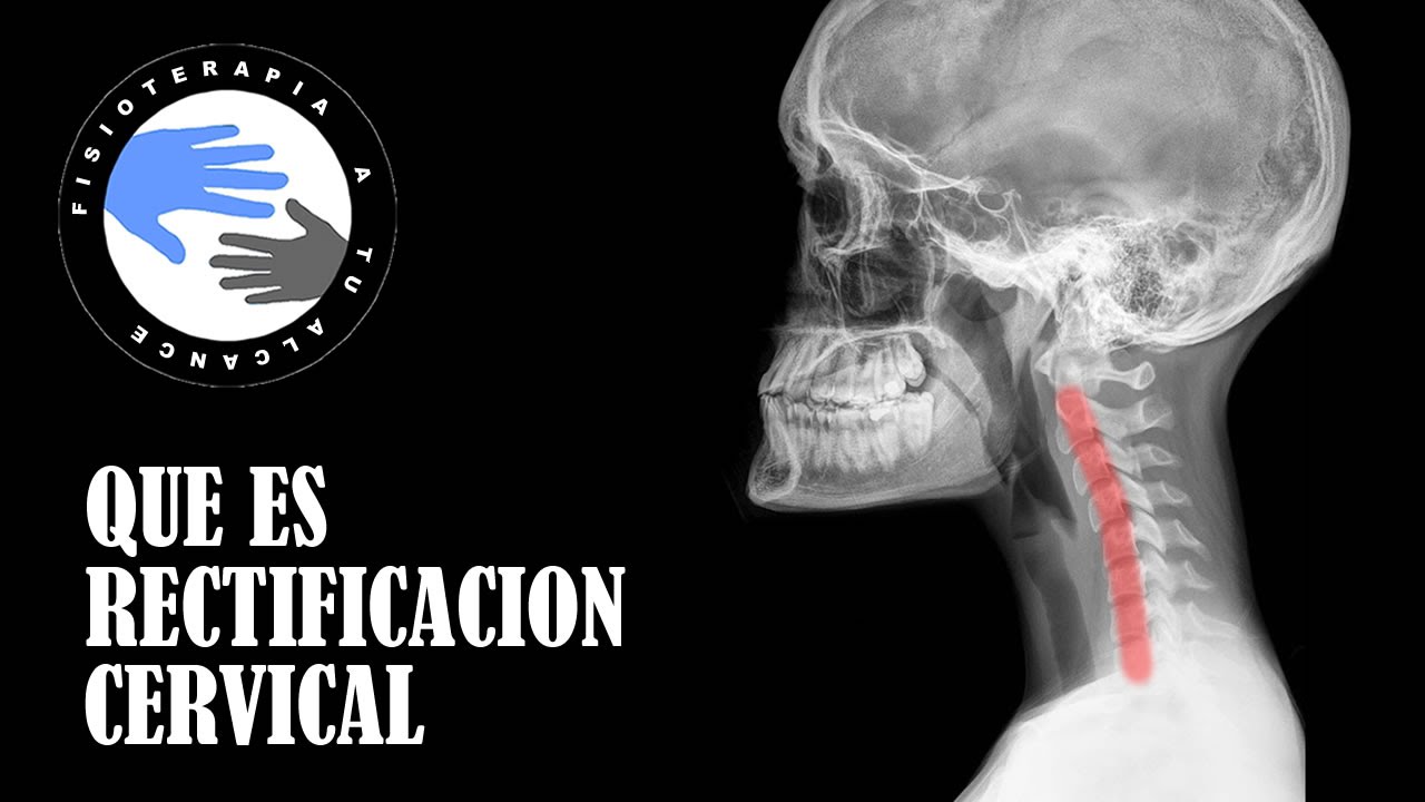 Rectificacion cervical, que es y como se produce