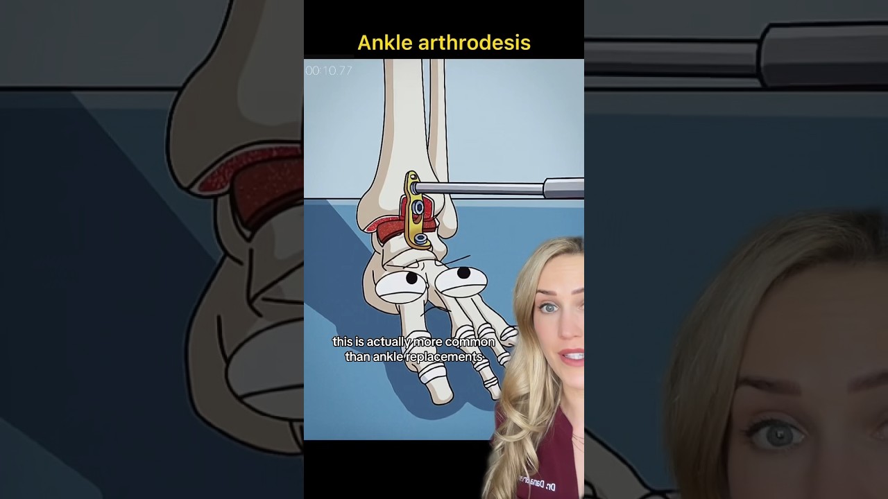Doctor explains: ankle fusion surgery