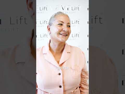 Viviana's 7-Day EVE Lift™ Progression | Eden Plastic Surgery: Dr. Ali Charafeddine, MD