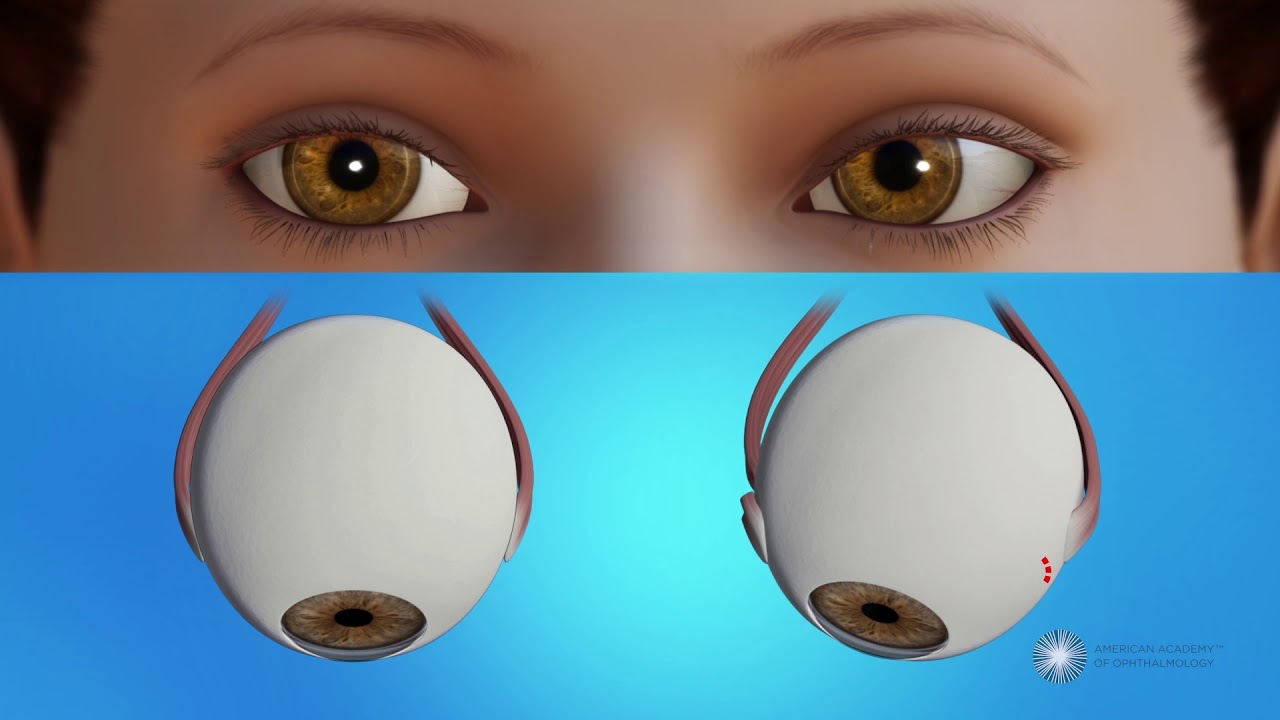 How is strabismus surgery done?